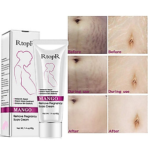 Scars Removal Cream, Mango Remove Pregnancy Scars Cream Stretches Marks Treatment Maternity Repair Firming Skin