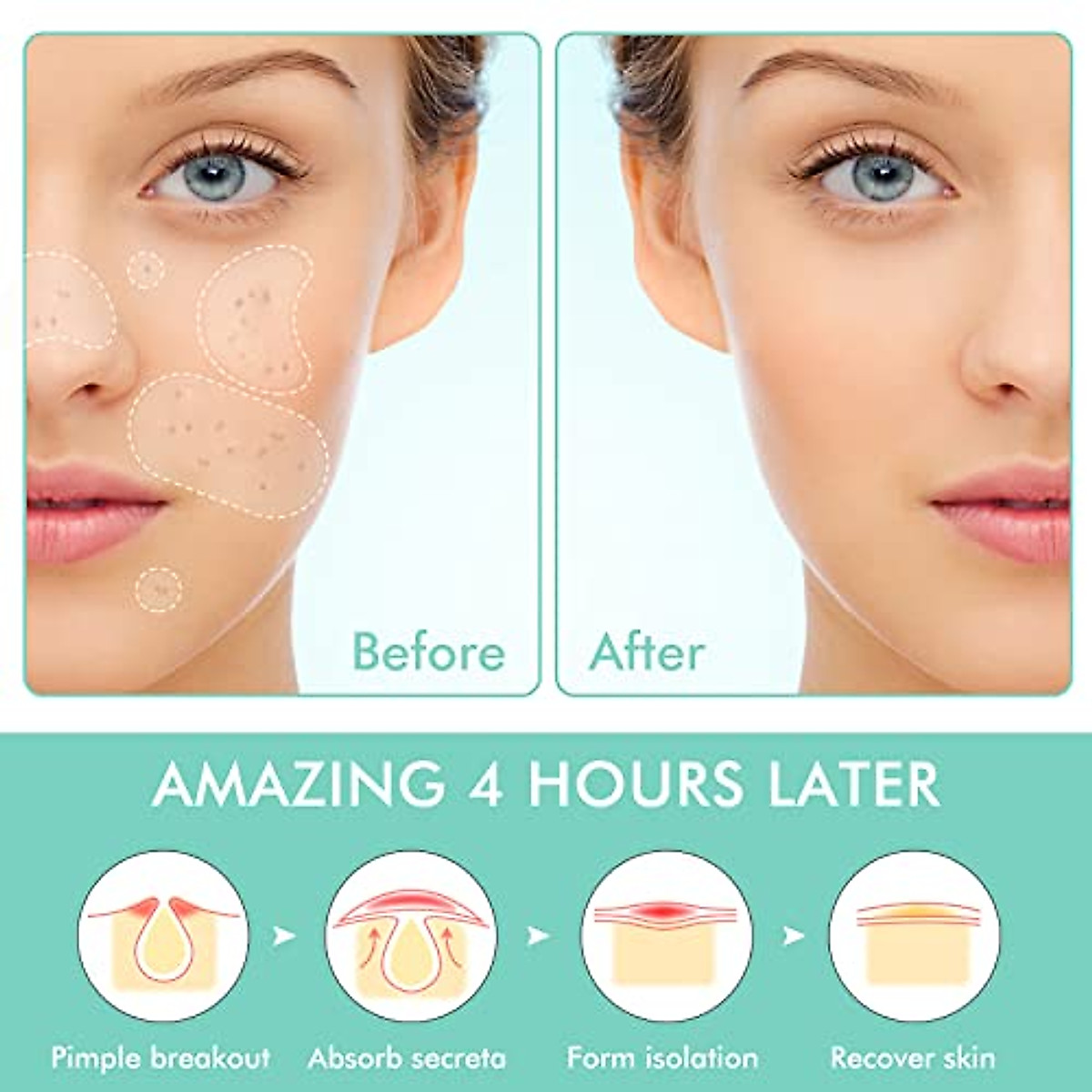 Mandabloom Acne Pimple Patches, 6 Sizes 104 Patches for Large Zit Breakouts, Acne Patches for Face, Chin or Body, Hydrocolloid Bandages Acne Treatment with Tea Tree & Calendula Oil & Salicylic Acid