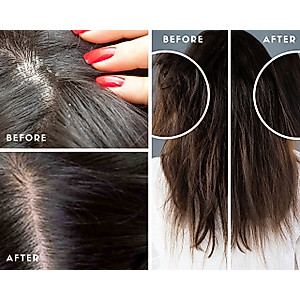 Herbal Dermatitis Dry Shampoo, Itchy Scalp Folliculitis Solution with Leave-In Tea Tree Oil Anti-Dandruff Conditioner for Men and Women. Safe and Effective for Sensitive Skin and Scalp.