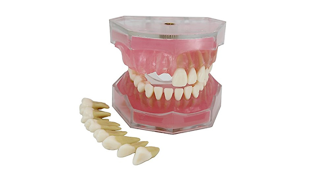 Dental Implant Model for Training and Teaching
