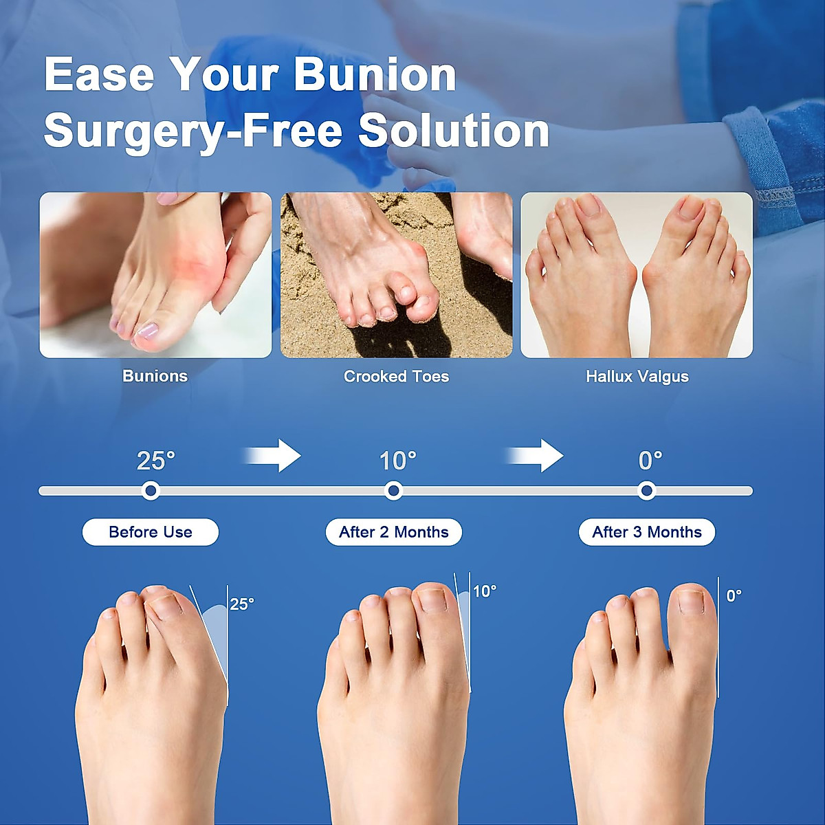 Bunion Corrector for Women Big Toe, Bunion Relief, 8pcs Toe Separators for Overlapping Toes Women, Toe Spacers For Feet Men, Bunion Splint w Pad, Hallux Valgus Toe Straighteners,Fix Bunions No Surgery