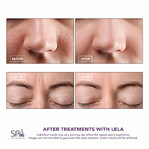 Spa Sciences - LELA - 4-in-1 Facial Spatula for Deep Cleansing, Pore Extraction, Serum Infusion, Anti-Aging and Contouring