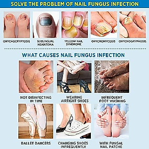 Toenail Fungus Treatment Extra Strength - Nail Fungus Treatment For Toenail, Toe Nail Fungus Treatment Extra Strength, Nighttime Fungal Nail Patches &amp; Fungus Nail Treatment Liquid Set (21patches+15ml)