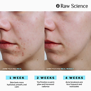 Anti Acne Supplements Cystic Acne Treatment for Teens – Hormonal Acne Pills with Acne Vitamins for Men & Women – clear skin supplement: Vitamin A, Zinc, Niacin Oily Skin & Breakout Control - 60 Caps