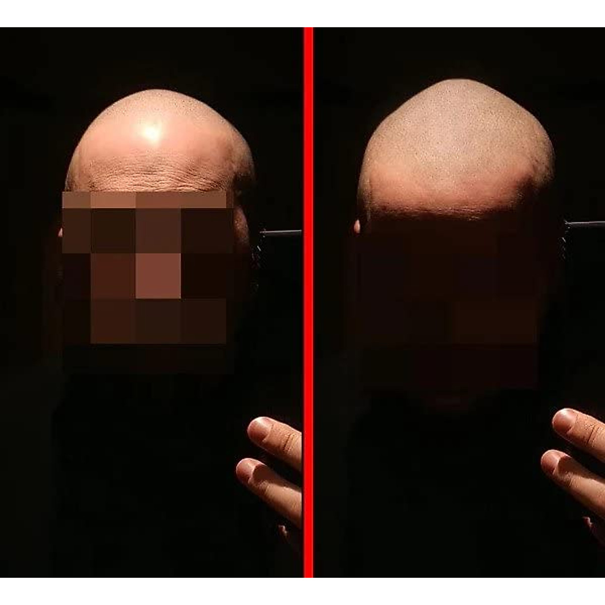 DermiMatch LLC Zero Shine 2.0 - Small - for scalp aftercare moisturizing mattifying effect for bald scalps or SMP Scalp Micropigmentation. Matte Scalp