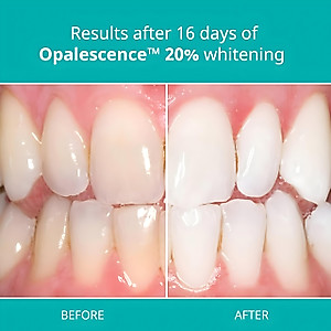 Opalescence 20% Teeth Whitening Refill Kit (2 Packs / 4 Syringes) Carbamide Peroxide. Made by Ultradent, Unflavored. Tooth Whitening Refill Syringes - B-5402-2