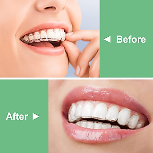 BVN Aligner Chewies, 10 Pieces Orthodontic Chewies, Retainer Chewies, Dental Chewies for Aligners, Orthodontic Dental Chewies Munchies, Green