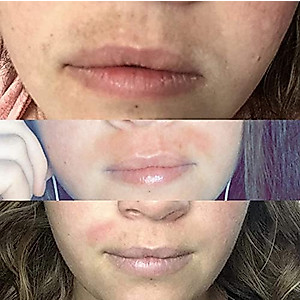 Dark Spot Corrector, Dark Spot Remover for Face, Melasma and Hyperpigmentation Treatment, Dark Spot Serum, Age Spot Remover, with Tyrostat, Kojic Acid, Alpha Arbutin, Mulberry Extract, Lactic Acid 1oz