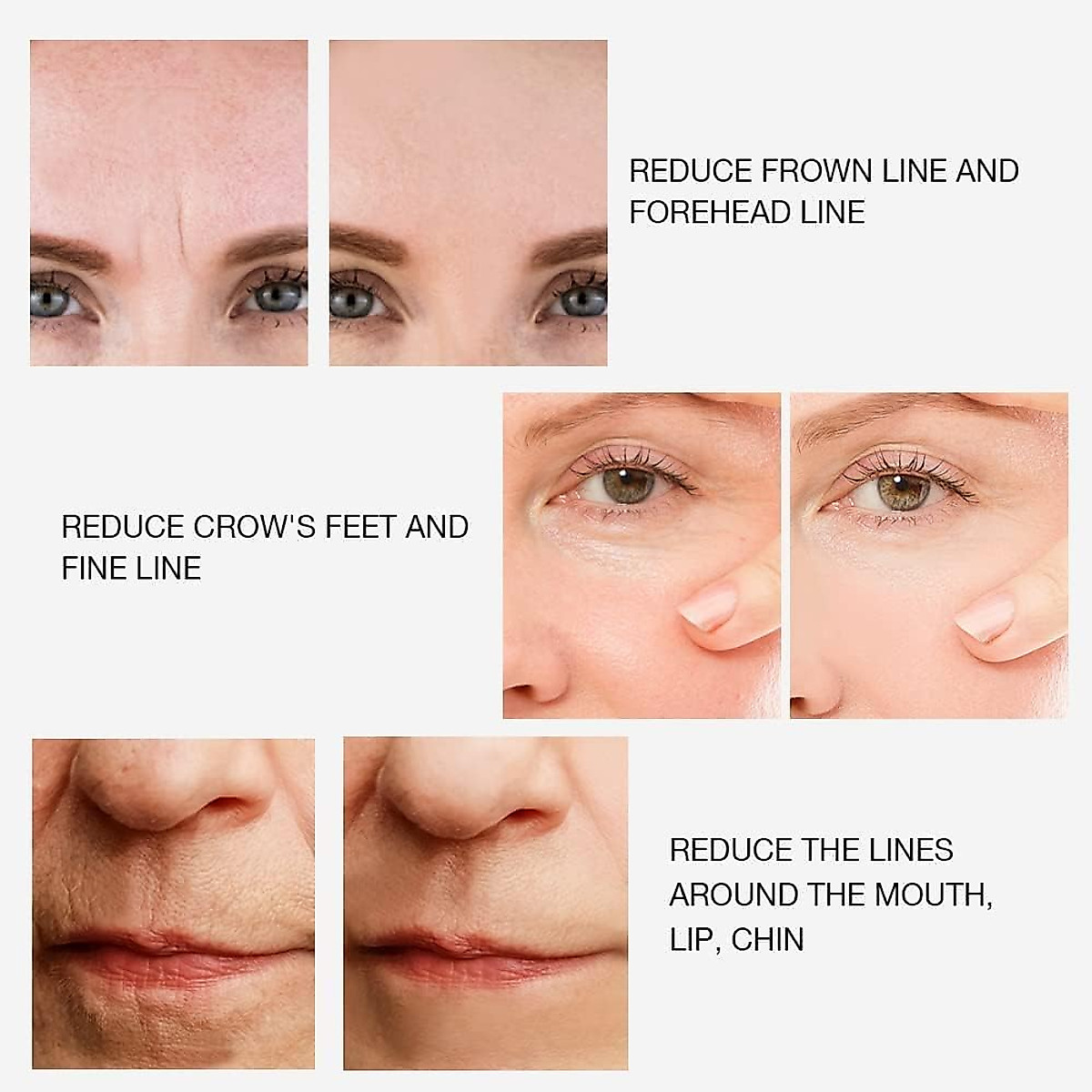 Radio Frequency Machine Professional 25 Watts Face RF Increase Collagen Firm Skin Wrinkle Reducing