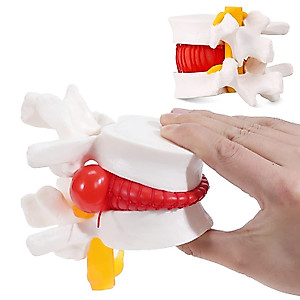ASINTOD Human Anatomy Lumbar Disc Herniation Model,A Model Showing The Anatomy of Human Lumbar Disc, An Excellent Choice for Teaching and Learning The Human Lumbar Spine