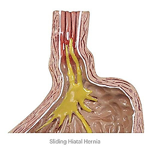 GPI Anatomicals - 4-Piece Stomach Model Set with Gastroesophageal Reflux Disease (GERD), Replica for Human Anatomy and Physiology Education, Anatomy Model for Doctor's Offices, Medical Study Supplies