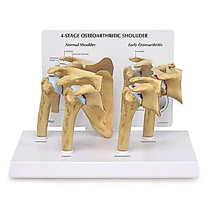 GPI Anatomicals Shoulder Joint Model Set | Human Body Anatomy Replica Set of 4-Stage Osteoarthritis Shoulder Joint for Doctors Office Educational Tool