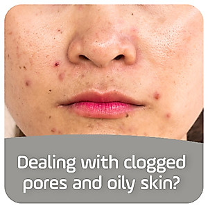 Asepxia Deep Cleansing Acne Treatment Bar Soap with Baking Soda and 2% Salicylic Acid, 4 Ounce