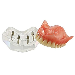 DENTALMALL Dental Upper Implants Model Overdenture with 4 Superior Teeth Demo Transparent Vision for Education and Study Model Tool M6001 C