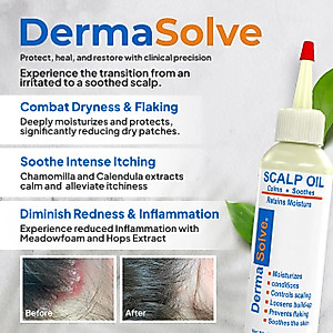 Dermasolve Psoriasis & Dandruff Oil, Dermatologist Approved for Flaky Scalp Relief