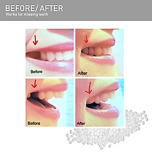 Teeth Repair Kit, Temporary False Teeth, Do it Yourself Thermal Fitting Beads, Moldable False Teeth for Snap On Instant and Confident Smile, Vivostar