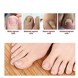 2PCS German Toenailplus Anti Paronychia Relief Oil, Anti Paronychia Relief Oil, Toe and Fingernail Repair for Damaged Discolored Thick Nails