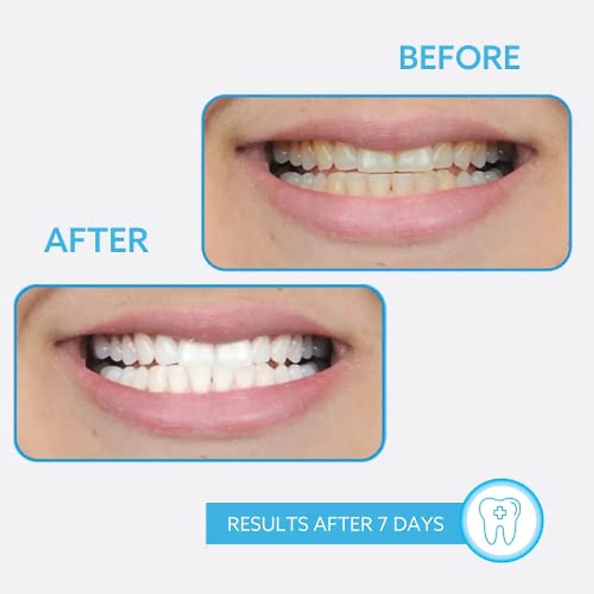 GO SMILE Extreme White Professional Teeth Whitening 7 Day Morning & Night System - Dentist Recommended & Clinically Proven to Whiten in 7 Days with No Sensitivity, 14 Single Use Whitener Applicators