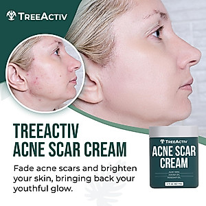 TreeActiv Acne Scar Cream, 2 fl oz, Acne Scar Treatment for Face, Stretch Marks, and Body Scars, Acne Scar Removal Cream for Body, Acne Scar Remover for Cuts and Burns, For All Skin Types, 500+ Uses