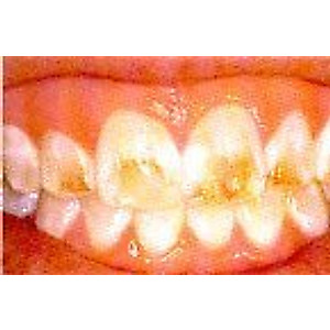 D.I.Y)10 Thermo-molding "BOIL and BITE" Mouth Trays by Instant White Smile Wholesale