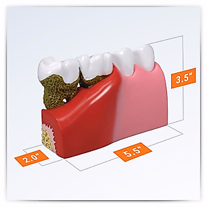 Dental Model | Human Body Anatomy Replica of Teeth w/Common Pathologies for Dentist Office Educational Tool | GPI Anatomicals