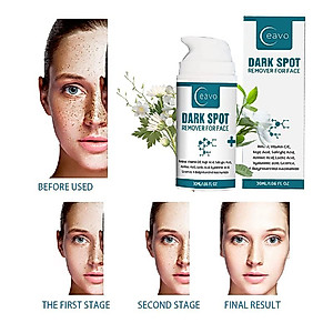 Dark Spot Remover For Face Serum With Vitamin C and E, Retinol, Salicylic Acid, Kojic Acid, Niacinamide, Azelaic acid, Lactic Acid, 4-Butylresorcinol, Licorice. Hyperpigmentation Treatment, Acne Scar Spot Treatment Fade Post-Acne Hyperpigmentation. Brown
