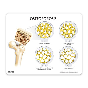 Osteoporosis Model | Human Body Anatomy Four Piece Hinged Disk Set of Progressive Bone Thinning for Doctors Office Educational Tool | GPI Anatomicals
