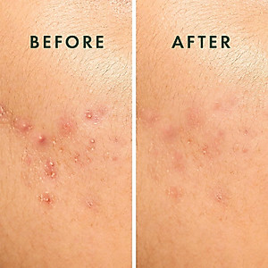 Rael Pimple Patches, Miracle Spot Control Cover - Hydrocolloid Acne Patch, Strips for Zits and Blemish, Korean Skin Care, Vegan, Cruelty Free (10 Count)