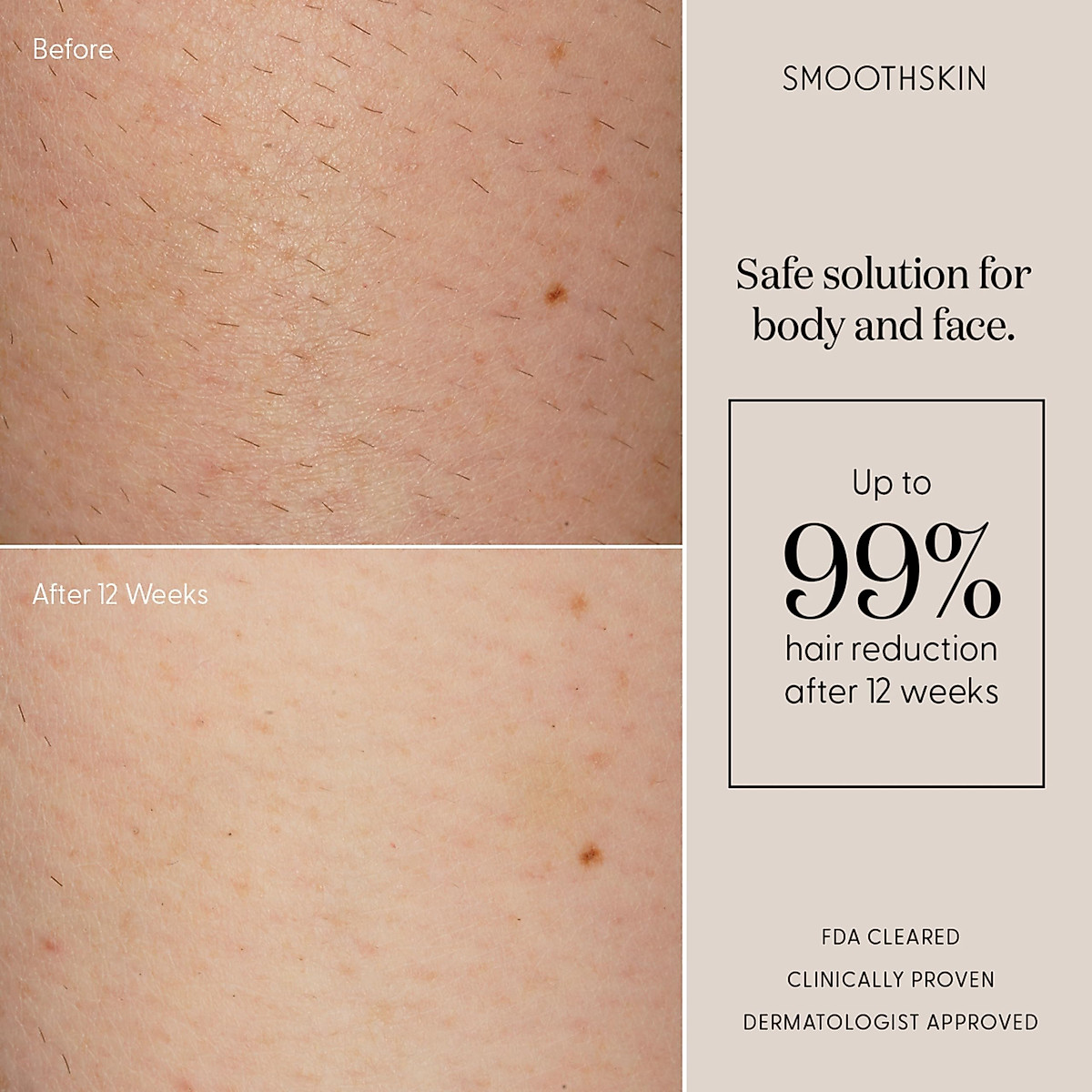 Smoothskin Pure Fit IPL Laser Hair Removal Device, for Body & Face, Long-Lasting Hair Removal from Home, Alternative to Laser, with Precision Head