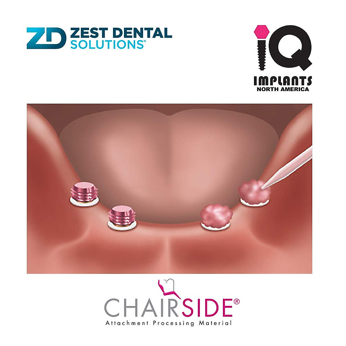 Zest Locator CHAIRSIDE Attachment Processing Material 8gm, 4ml Normal Set