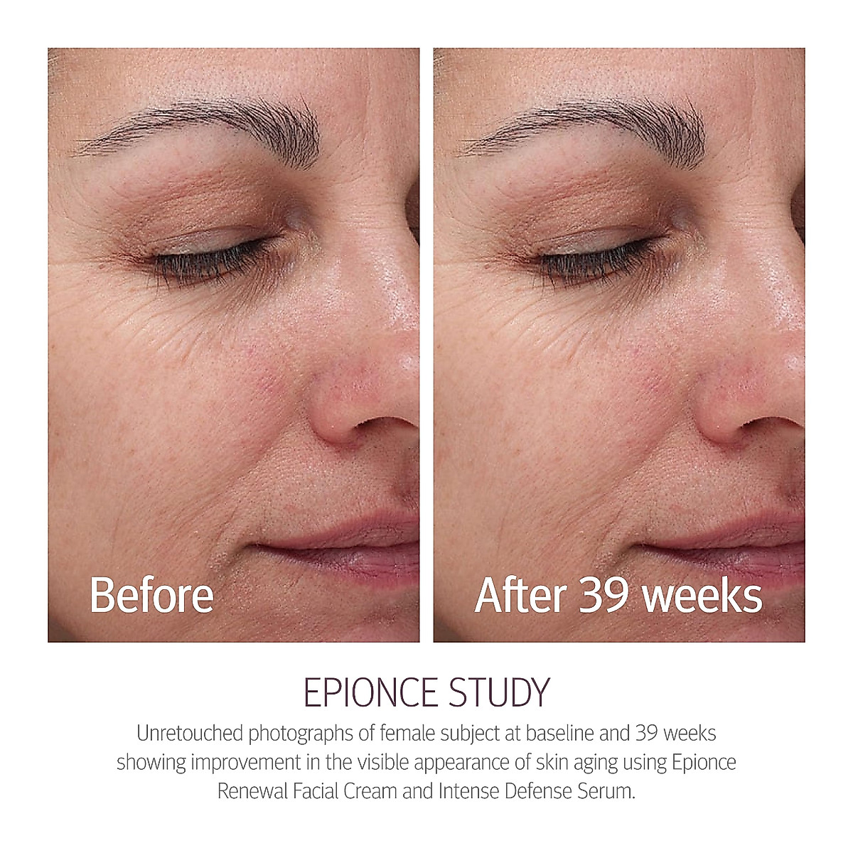 Epionce Renewal Facial Cream - Hydrating, Anti-Aging Moisturizer for Dry & Sensitive to Normal Skin, For Fine Lines & Wrinkles, Dermatologist Skincare