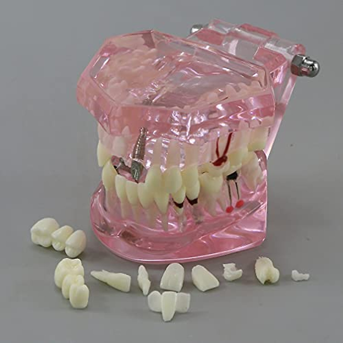 Dentalmall Teeth Model Teeth Typodonts Dental Implant Study Analysis Demonstration Teeth Model #2001 with Restoration Pink