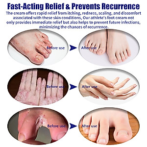 Tea Tree Draw Salve Soothing Cream, Itchy Feet Relief, Jock Itch, Foot Odor, Balls Ringworm, Psoriasis, Eczema, Rash, Dry Cracked Heels, Athlete's Foot, Itching, Burning, Cracking, Scaling Treats