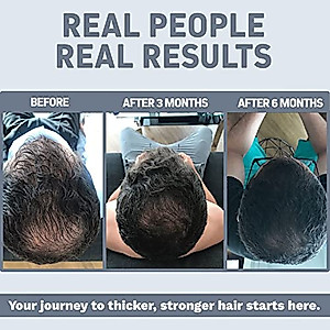 Foli-Tonic DHT Blocker & Hair Loss Supplement | Hair Thinning Treatment & Promotes Healthy Thicker Hair Growth | with Saw Palmetto & Biotin for Men & Women | 60 Vegan Capsules (60 Count (Pack of 1))