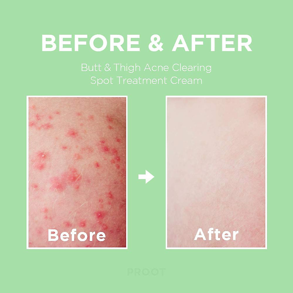 Butt Acne Treatment Cream in Tube Type | Travel Friendly | Clears Acne, Ingrown Hairs, Zits, Razor Bumps, Blackheads and Dark Spots for the Butt, Thigh and Other Sensitive Area | Prevents Future Breakouts