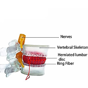 DenFactory Human 1.5 Times Life-Size Transparent Lumbar Disc Herniation Spine Model for Teaching and Learning