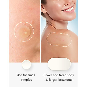 LitBear Large Acne Pimple Patches, 5 Sizes 80 Patches for Large Breakouts, Acne Patches for Face, Chin or Body, Acne Spot Patch with Tea Tree & Calendula Oil, Hydrocolloid Bandages for Acne Skin