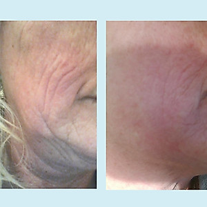 Lactic 50% Gel Peel, Chemical Peels for Face Breakout Scars, Chemical Exfoliant for Face, Strength Level 2, 1.0 fl oz. e, 30 mL – Perfect Image