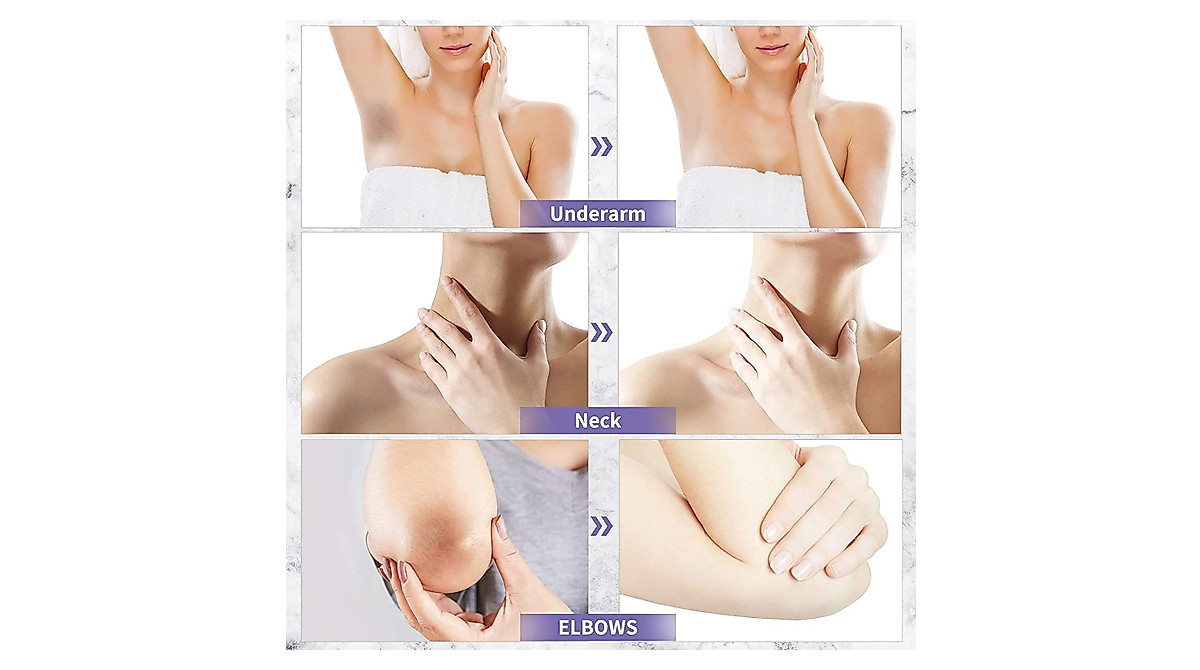 Acclyd Dark Spot Corrector Skin Lightening Cream for Body, Intimate Areas, Underarms, Armpit ...