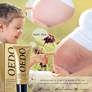 Rose Remove Stretch Marks Cream for Pregnancy Scar Removal Cream Natural Plant Essence Formula Prevention Remove Stretch Mark Old Scars Body Moisturizer 40g