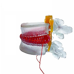DenFactory Human 1.5 Times Life-Size Transparent Lumbar Disc Herniation Spine Model for Teaching and Learning