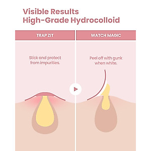 GLAM UP Performance Hydrocolloid Blemish Pimple Zit Patches - Ultra Thin Invisible Spot Cover Patches for Face and Skin, Strong Water-proof and Adhesive Overnight, Vegan-friendly (108 Count / 2Sizes)