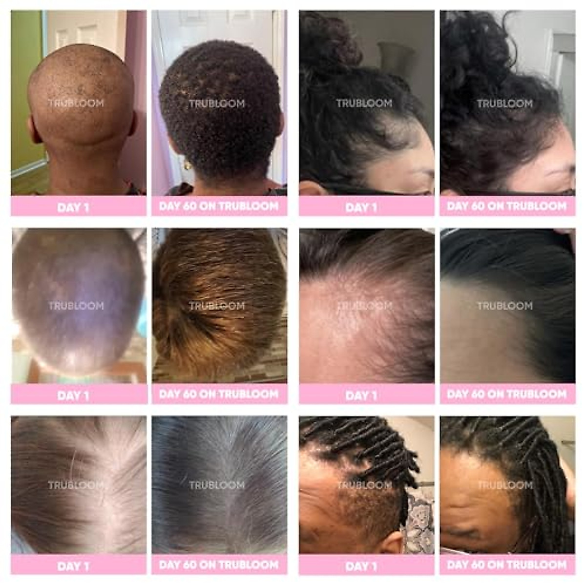 Tru Bloom Hair Growth Vitamins - 1 Month Supply. Clinically Proven for Fuller, Thicker Hair. Natural & Drug-Free. Ultimate Hair Vitamins for Proven Results