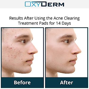 Acne Clearing Treatment Pads- Eliminates Acne Breakout Causing Bacteria. Clear Away Clogged Pores, Oily Skin, Blemish, Blackhead, Pimple, Cystic Breakouts. Contains Salicylic, Glycolic & Lactic Acid.
