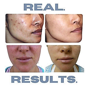 Clearogen Hormonal Acne Solution Natural Anti-DHT Ingredients Deluxe Set Original Formula Benzoyl Peroxide 2 Month Supply 3 Piece Set