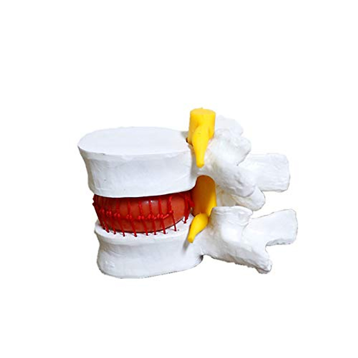 Global-Dental Anatomical Herniated Lumbar Vertebrae Disc Prolapse Model Human Anatomy Model White