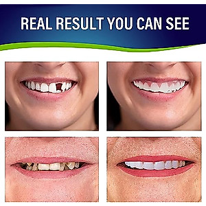 Fáke Têeth, 2 PCS Denture Teeth for Women and Men, Comfortable Dental Veneers for Upper and Lower Jaw, Nature and Realistic, Temporary Teeth Repair, Help You Regain Confident Smile