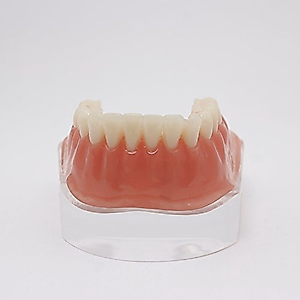 Dental Teeth Model Precision 4 Implant Overdenture Inferior Tooth Golden Color