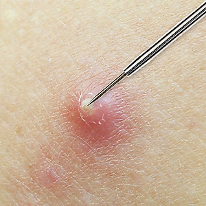 Beaute Galleria Needle Blackhead Remover Pimple Extractor Popper for Acne Comedone Blemish Whitehead Zit Removal Tool