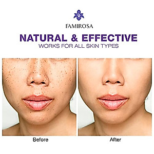 Dark Spot Remover for Face - Dark Spot Corrector Serum for Sun Spot Brown Spots Stubborn Spots-Freckle Remover - Melasma Hyperpigmentation Treatment Formulated with 4-Butylresorcinol, Kojic Acid and Hyaluronic acid- 50 ml